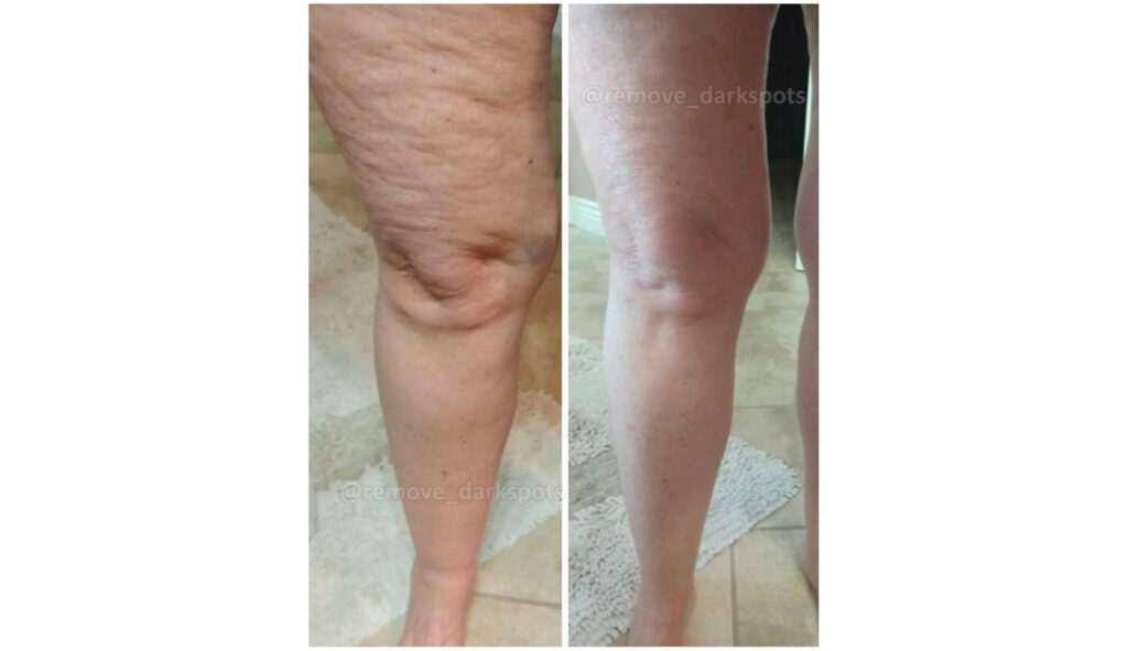 CELLULITE TREATMENT (PORTABLE) - ISIS.GOLD